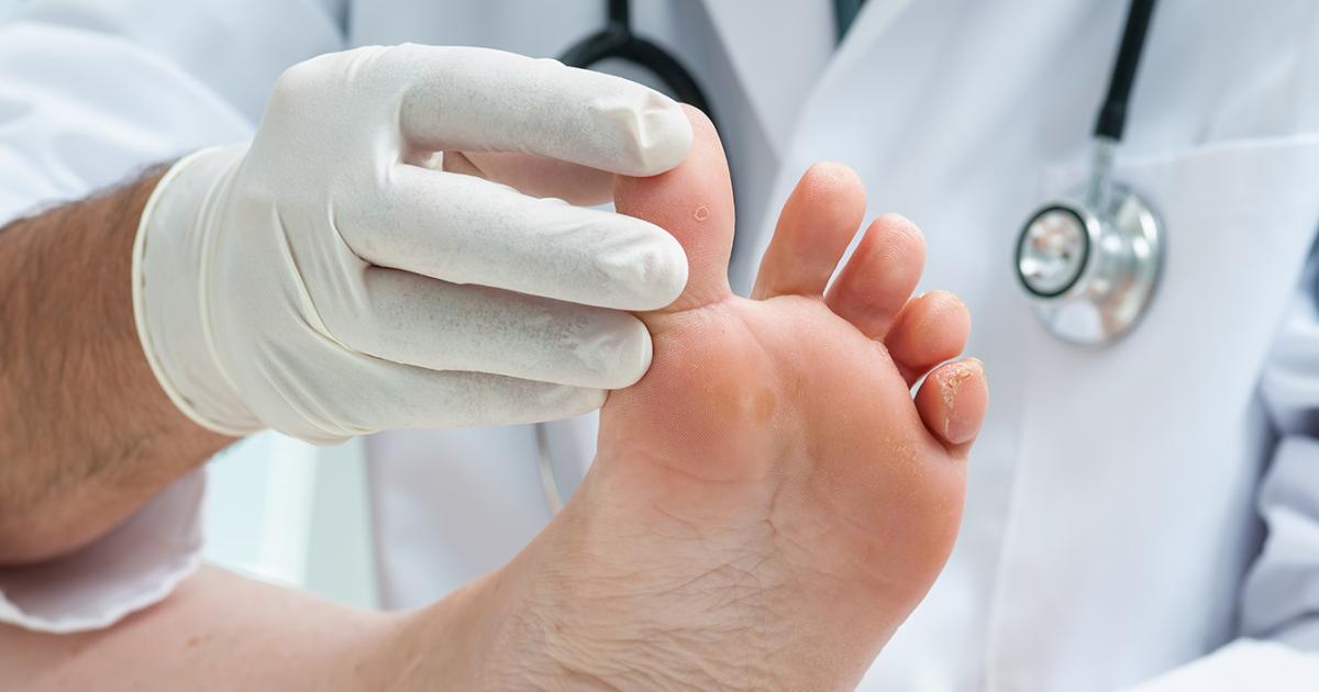 Pilzinfektion (Mykose) der Haut: Symptome, Behandlung