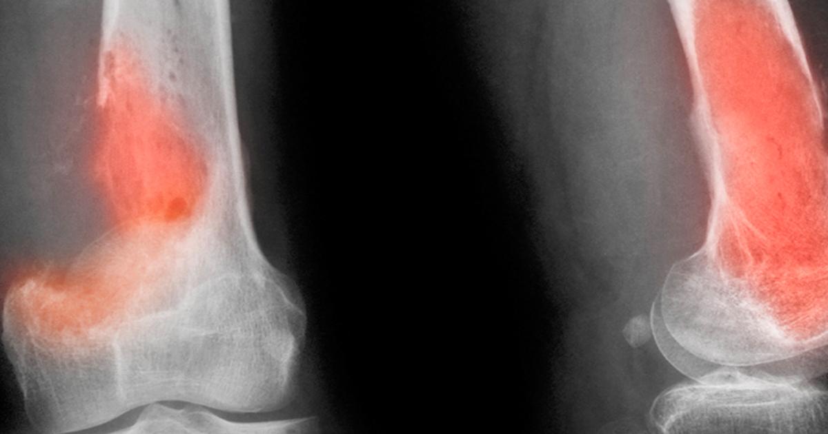 Knochenkrebs: Symptome und Lebenserwartung