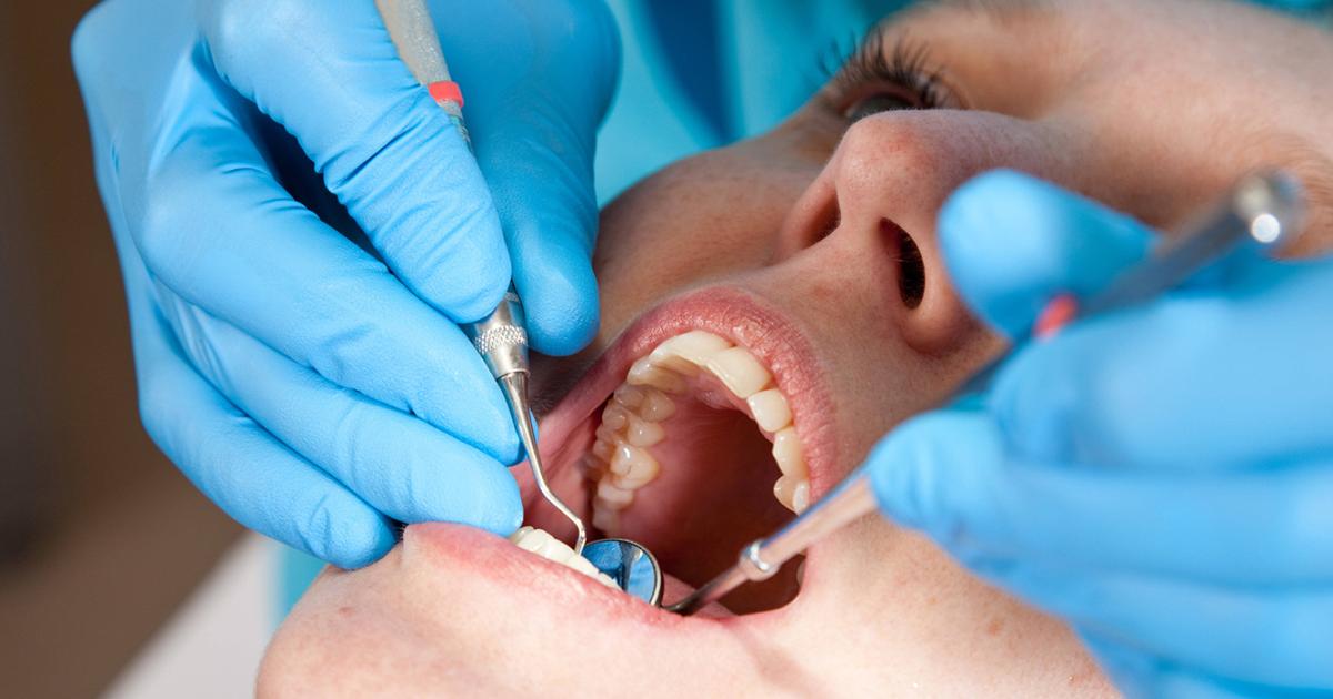 Karies frühzeitig erkennen und heilen