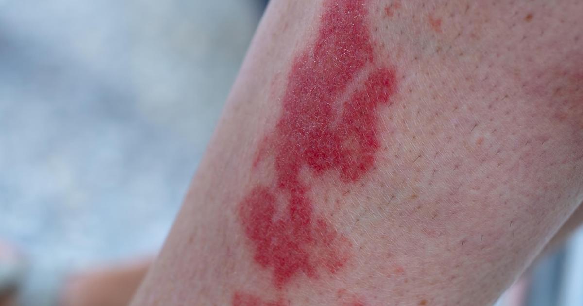 Das Vaskulitis-Rad: Vaskulitis Rad Ansatz – FSQRD